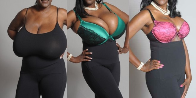 Woman Undergoes Reduction Surgery After A Rare Hormonal Condition Made